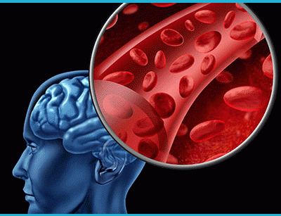 Accidentes Cerebrovasculares