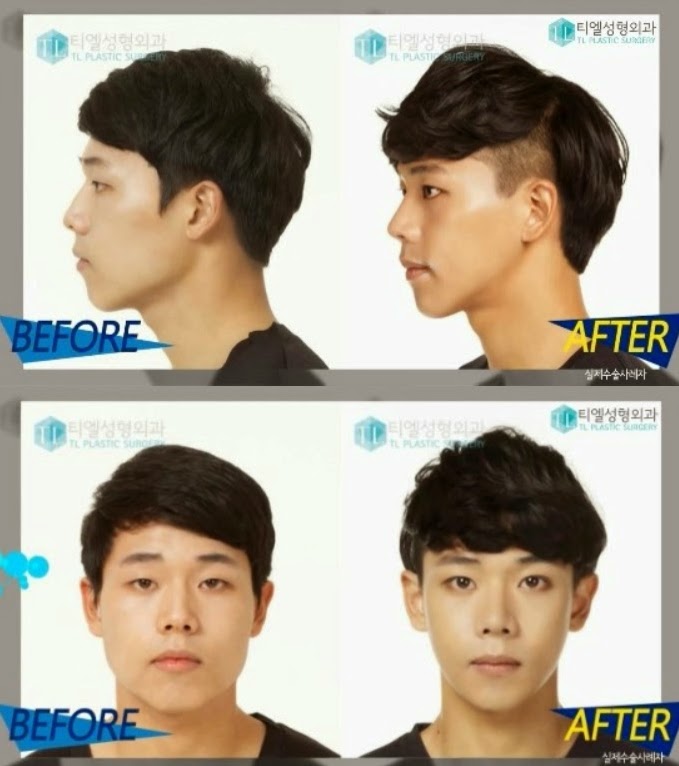 Bệnh Viện Thẩm Mỹ TL Hàn Quốc: [Men's beauty] Ideal shape of Men's nose