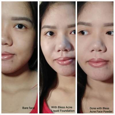 REVIEW] BLESS ACNE SERIES (MERAWAT KULIT BERJERAWAT DI RUMAH ...