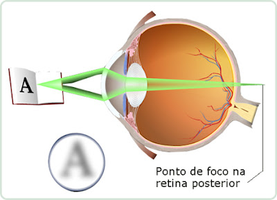 Presbiopia ~ DUNIA OPTICAL