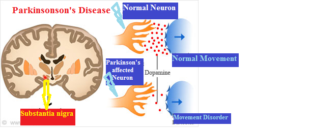 pharmacology: Parkinson's Disease