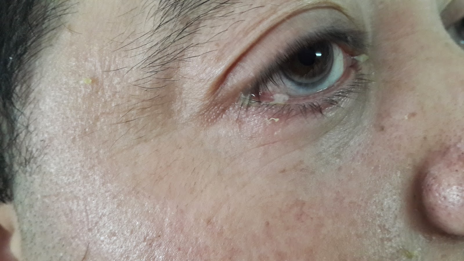 tajea journal of medicine: INFECCIÓN GONOCÓCICA DISEMINADA EN VARÓN DE ...