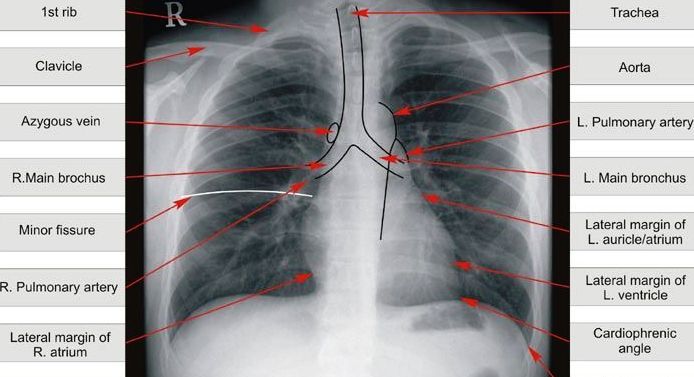 Knowledge Update : Chest X - Ray interpretation