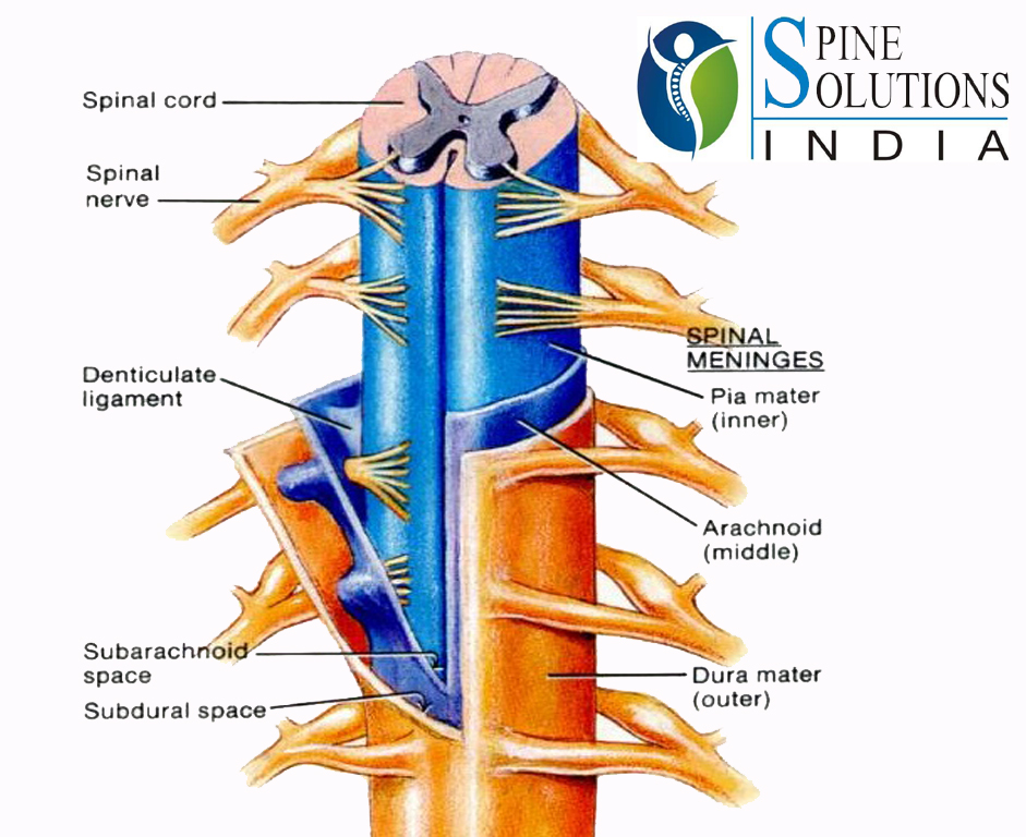 Spine Solutions India by Dr Sudeep Jain: Arachnoiditis: A Chronic Pain ...