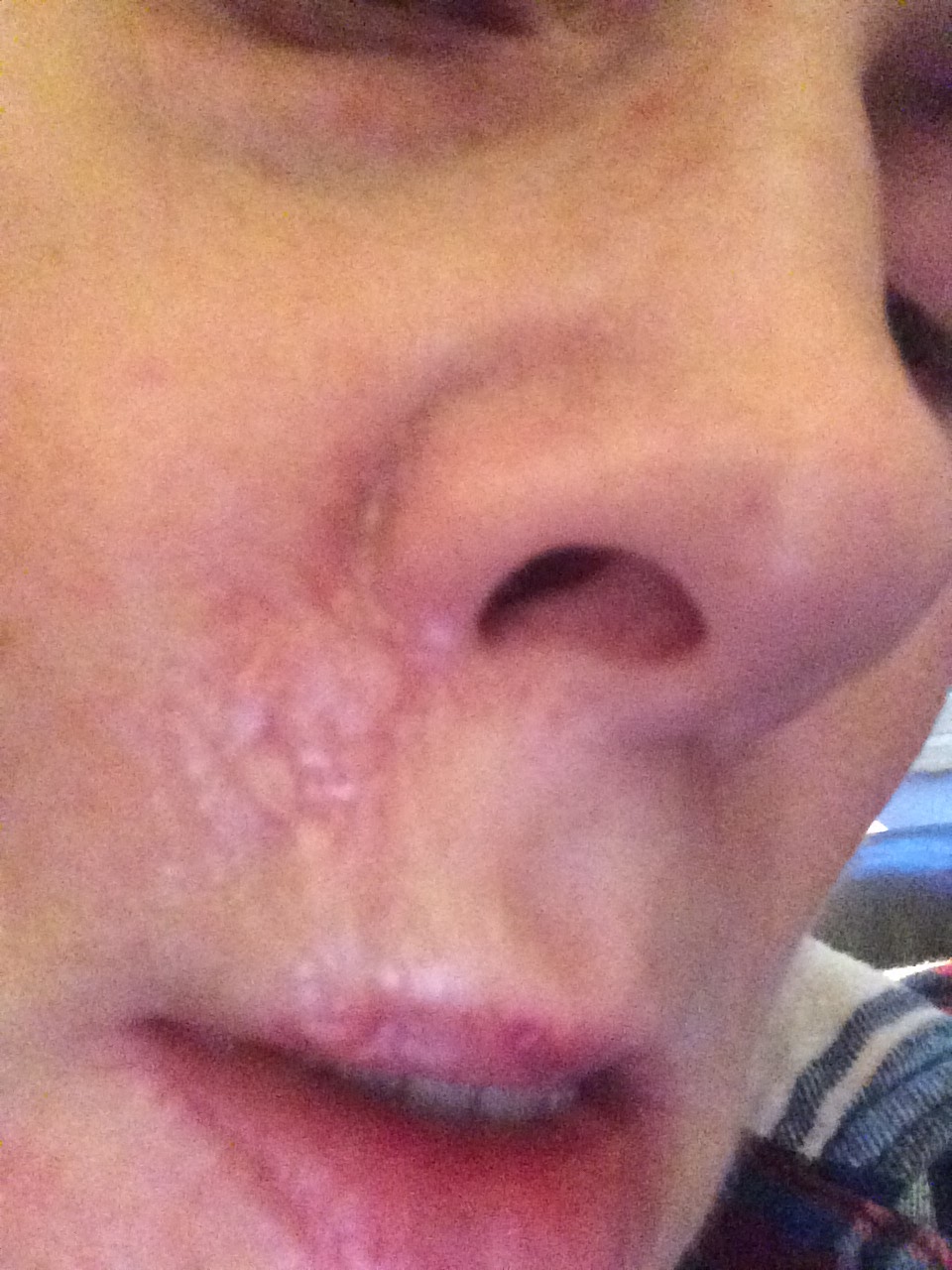 BraveFace . Diary of a facial basal cell carcinoma ( bcc): Week end