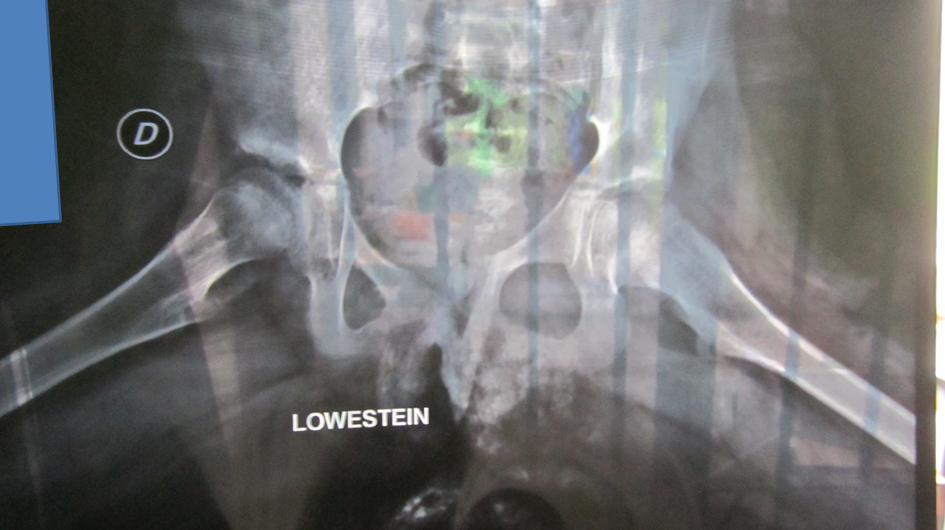 The Fascia Therapy Blog: Navigating Hip Pain in Cerebral Palsy