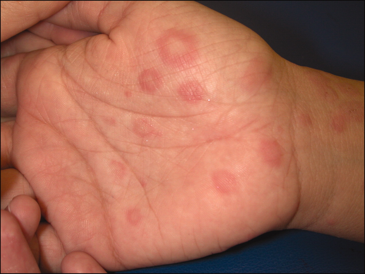 Penyakit Herpes Pada Tangan Jualanobatherbal penyakit-herpes-pada-tangan-jualanobatherbal