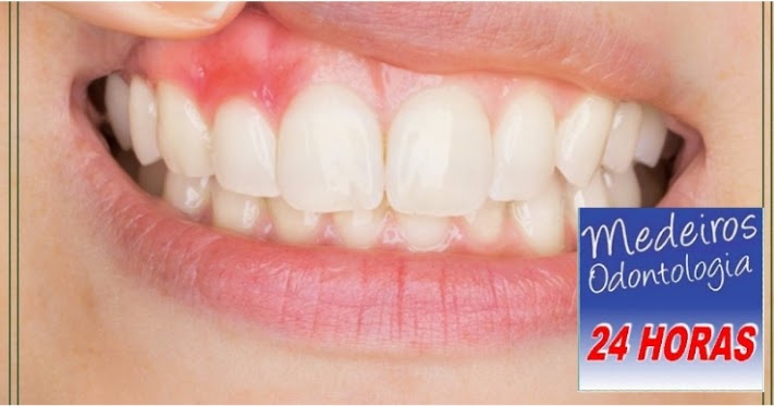 Medeiros Odontologia 24 Horas: O que é gengivite? Causas, sintomas ...