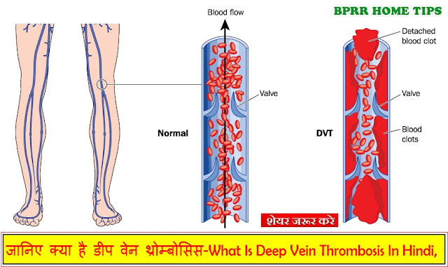 जानिए क्या है डीप वेन थ्रोम्बोसिस-What Is Deep Vein Thrombosis In Hindi ...