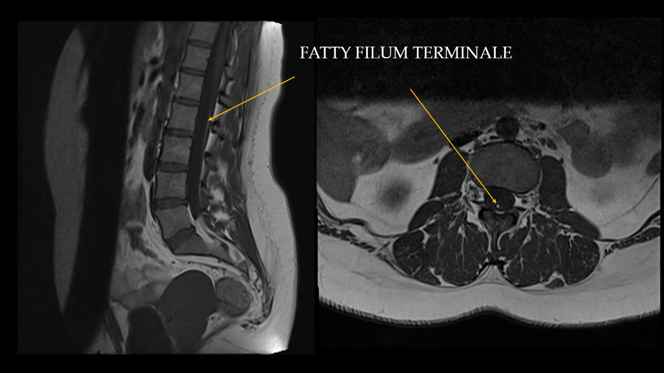 Filum Terminale Lipoma