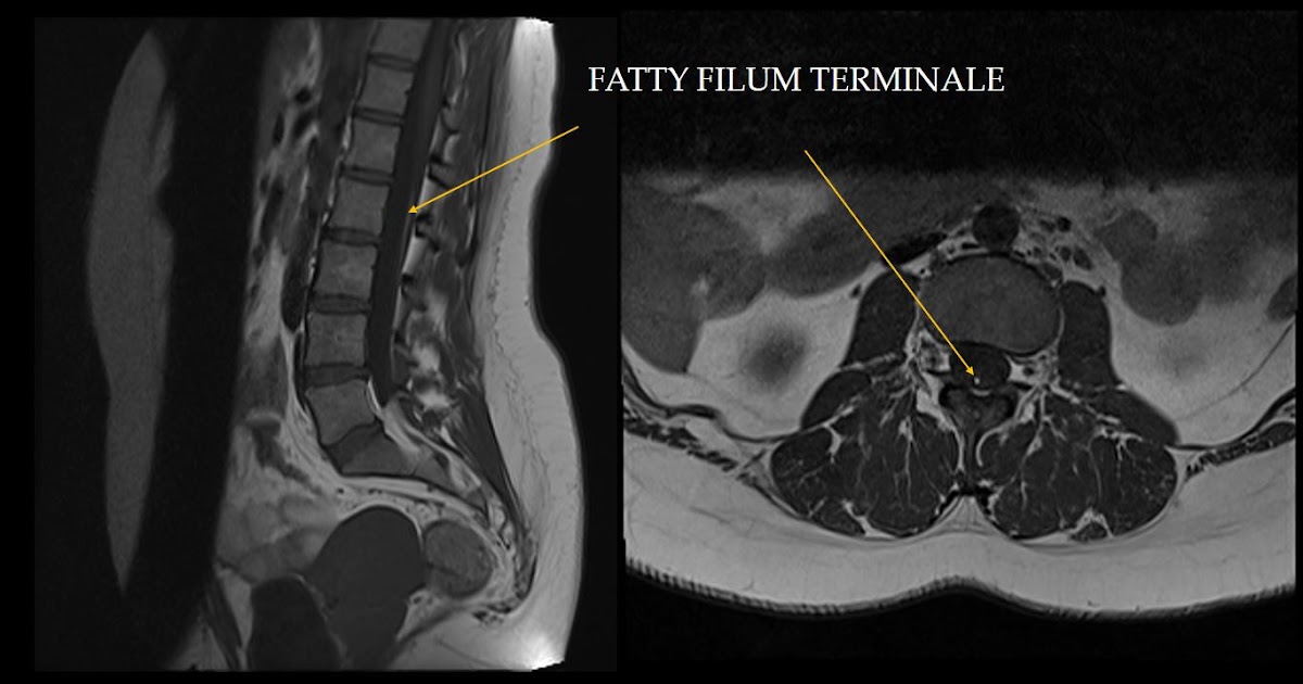 Ultimate Radiology : Fatty filum terminale