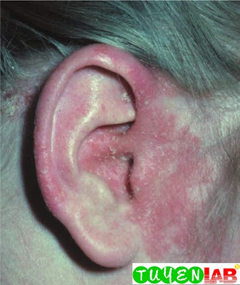 [Pediatric] Atlas of Otitis externa | Free Medical Atlas