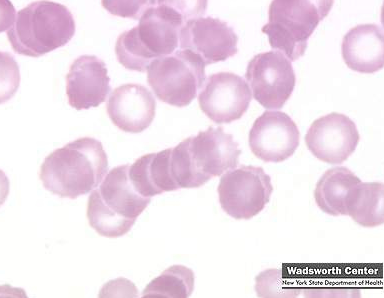 FICHERO DE HEMATOLOGÍA: ANORMALIDADES ERITROCITARIAS. Anormalidades de ...