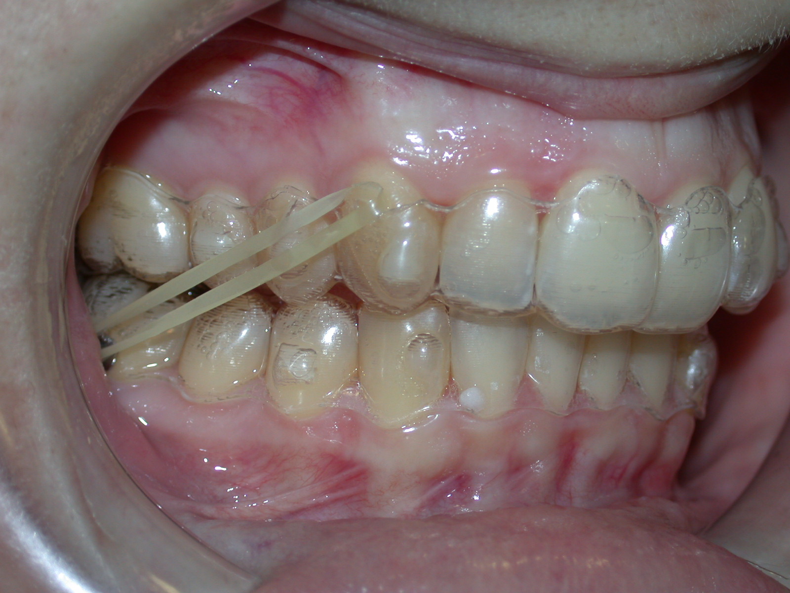 Diario de mi Invisalign: ¡Dos aligners más!