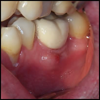 FRENKENKLINIK: Zahnabszess