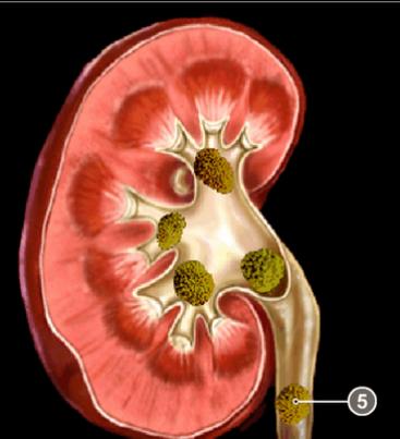 Fisiologia Fantástica: Nefrolitíase