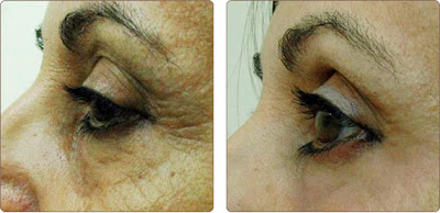 Pixel Skin Resurfacing by Beauty Redefined
