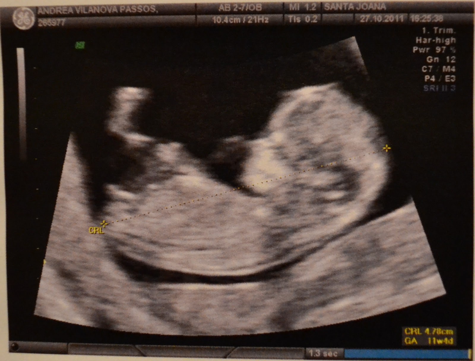 Leonardo - Leo: Ultrassom Morfológico de 11 Semanas!!