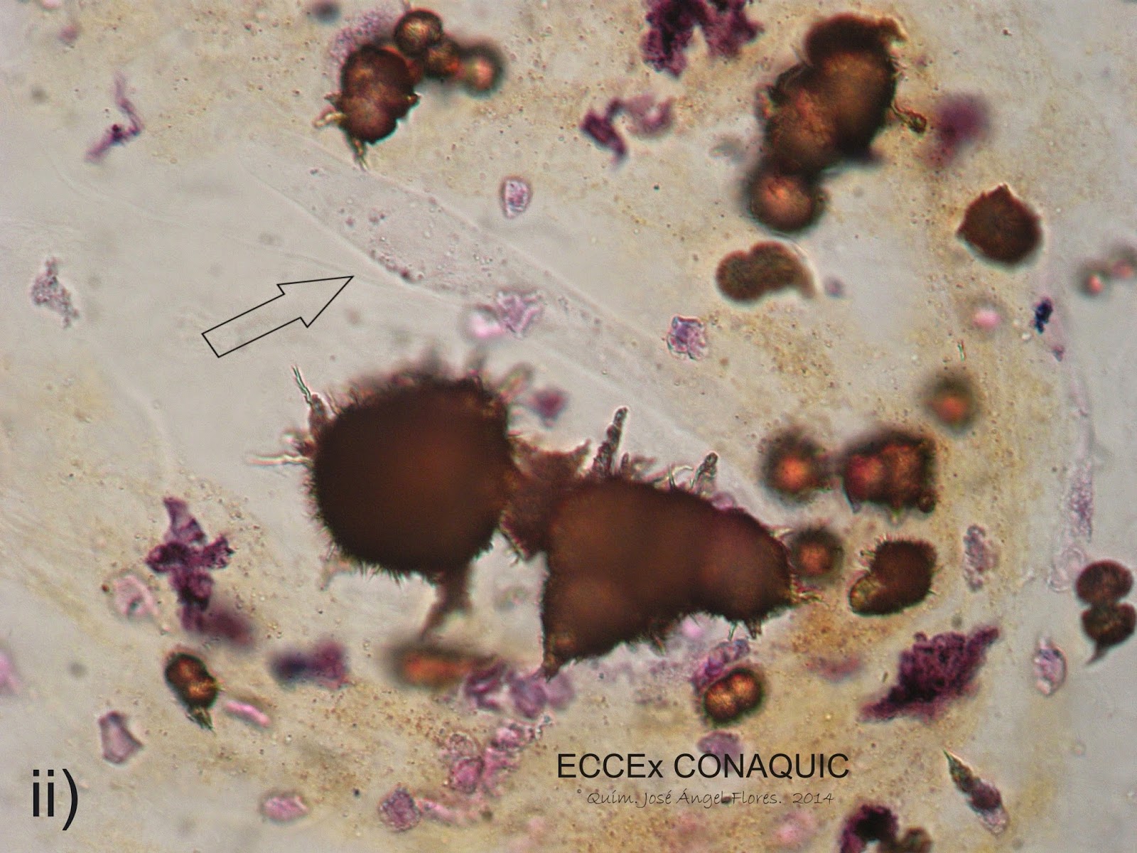 Caso UR-abril-14 (Enfoque: cristaluria)