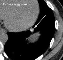 RiT radiology: Calcification in Lung Nodule