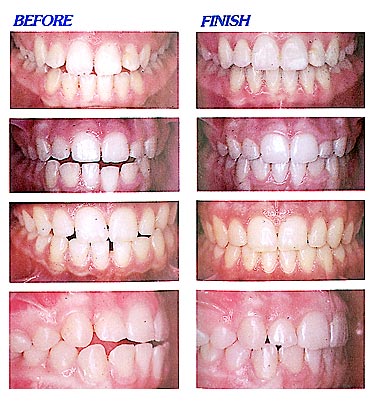 Dental sky - All about healthy smile: Tooth Positioners For Smile Designing