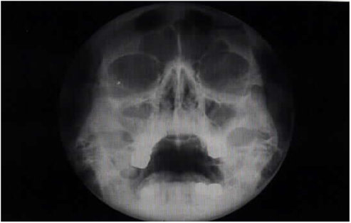Dentistry and Medicine: Maxillary Sinus in Health and Disease-Oral ...