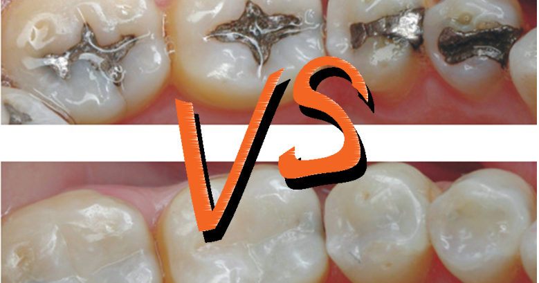 Amalgam vs Composite Resin