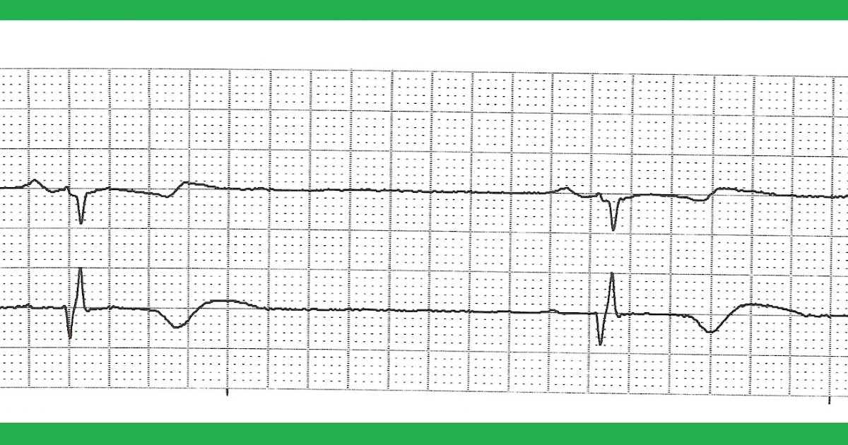 ACLS review: Pulseless Electrical Activity- part 1