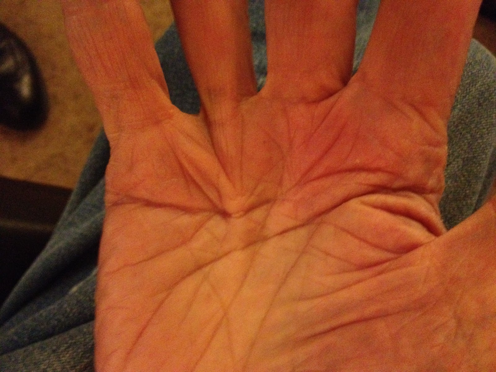 Gullible's Travels: A Mild Case of Dupuytren's Contracture