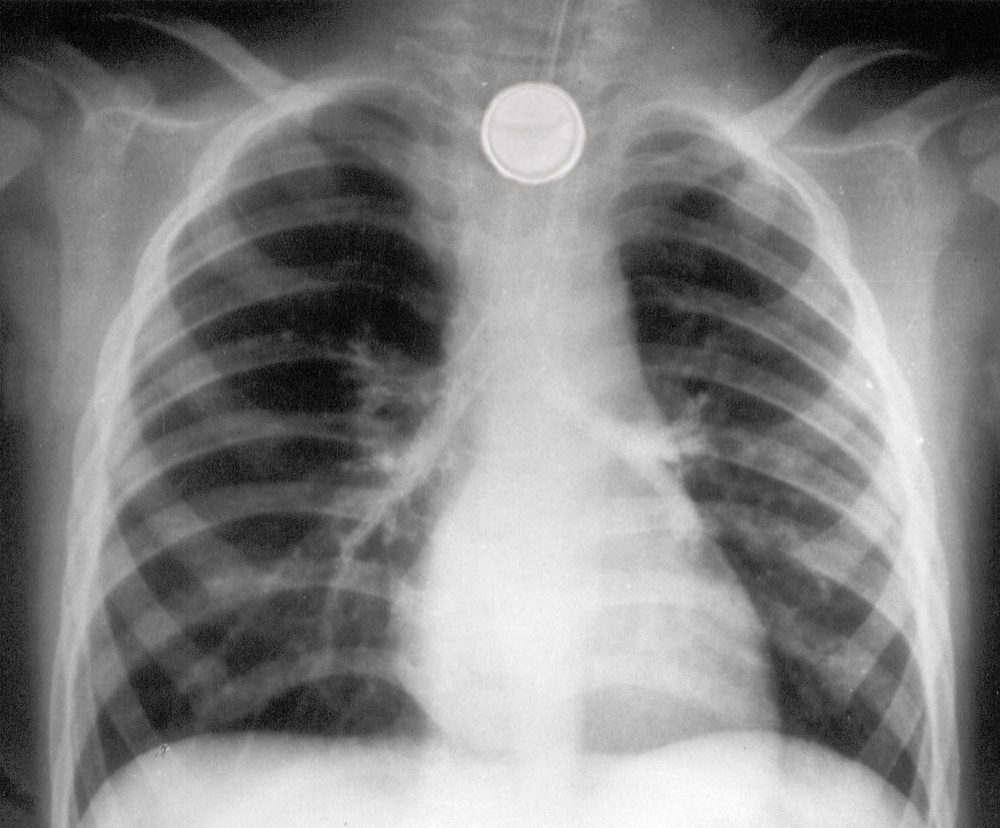 Drinking Honey Reduces Throat Damage after Swallowing Button Battery ...