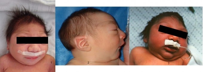 Patologias Humanas : Microcefalia