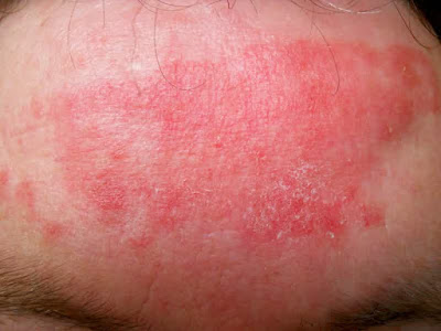 Acute Pain - NCP for Eczema (Dermatitis) - NURSING DIAGNOSIS