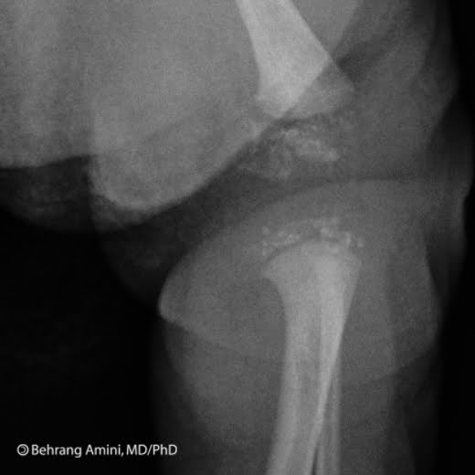 Stippled Epiphyses Differential Diagnosis - Radiology Imaging
