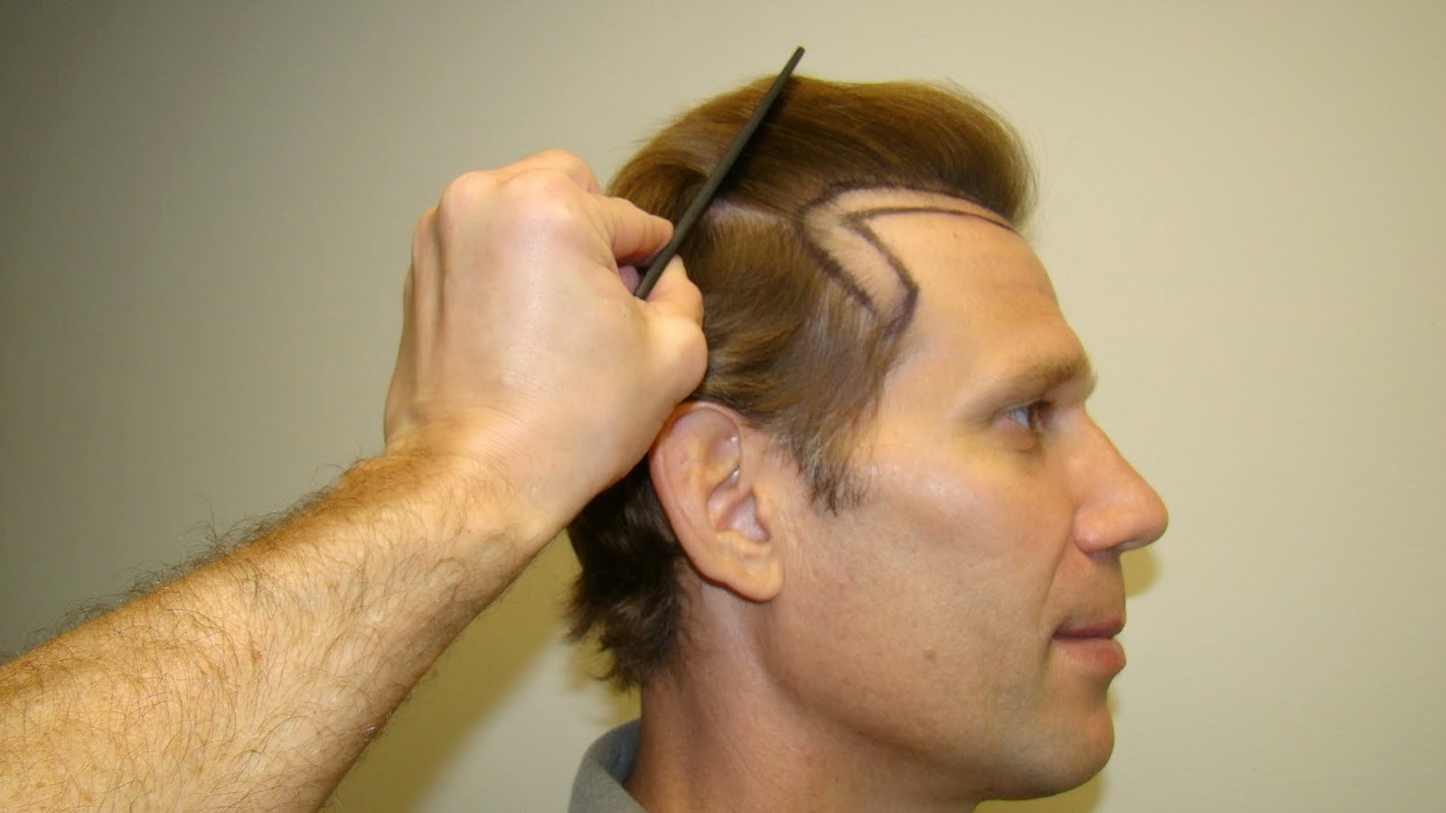 Tips on Hair Transplant Surgery In Delhi