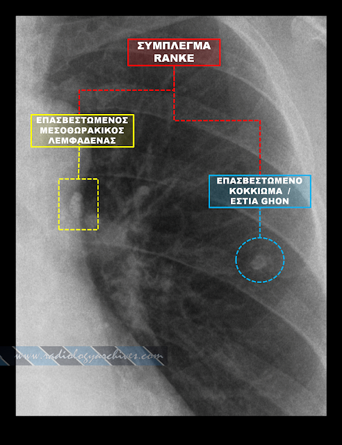Radiology Archives: Πρωτοπαθές Σύμπλεγμα Φυματίωσης (Σύμπλεγμα Ranke)