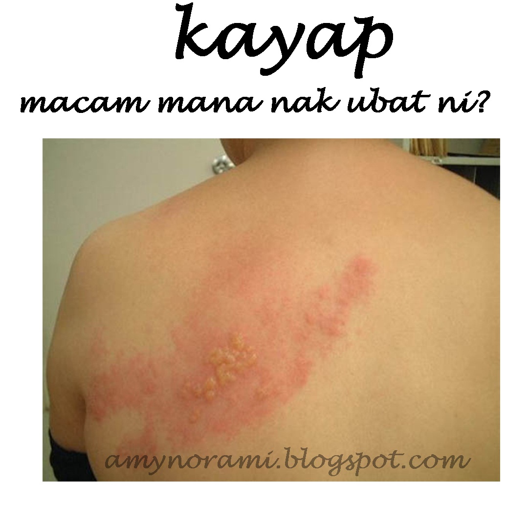 Sakit Kayap - Perumperindo.co.id