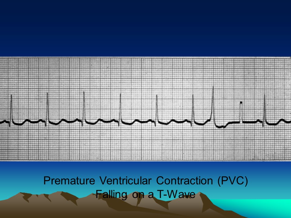 CVT Mohd Farid: Electrocardiogram ECG Part III Basic ECG Rhythm Pattern ...