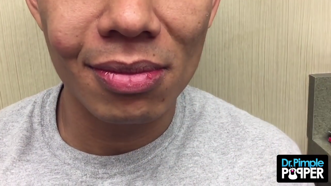 WATCH : A Big Cyst SQUEEZE on the cheek