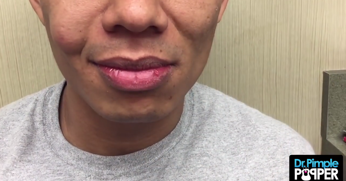 WATCH : A Big Cyst SQUEEZE on the cheek