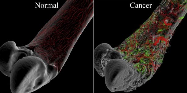 Tipos de câncer ósseo - Causa e sintomas de câncer ósseo - Artigos ...