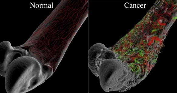 Tipos de câncer ósseo - Causa e sintomas de câncer ósseo - Artigos ...