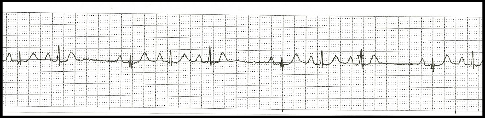 EKG Rhythm Strip Quiz 111