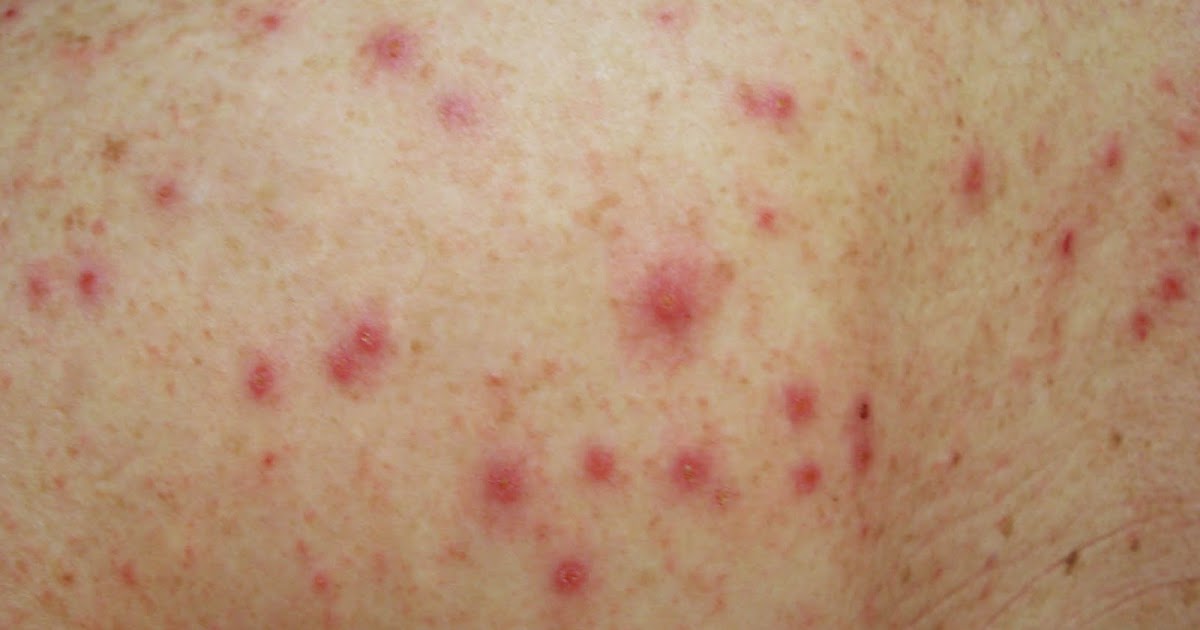 VIRTUAL GRAND ROUNDS IN DERMATOLOGY 2.0: A Case for Diagnosis