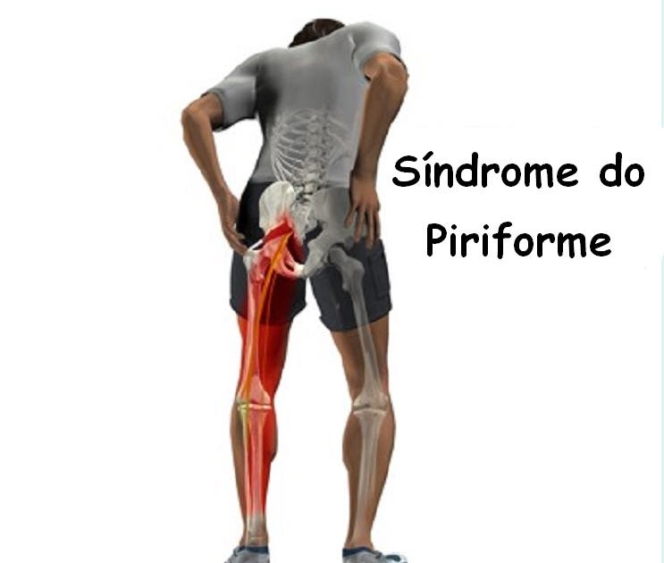 Blog do IOC: Síndrome do Piriforme: causas, manifestação e tratamento