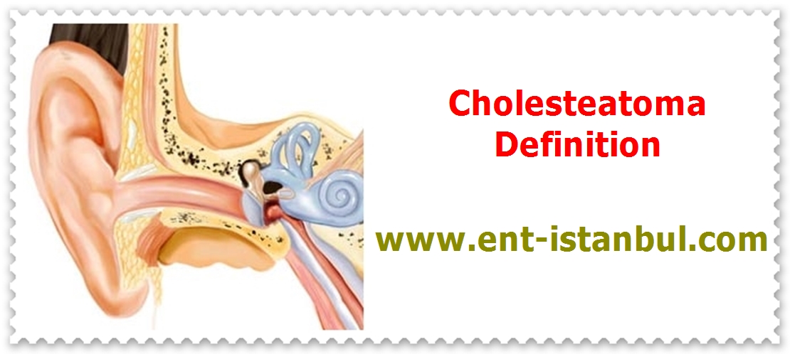 Cholesteatoma - Definition, Symptoms, Complications and Treatment