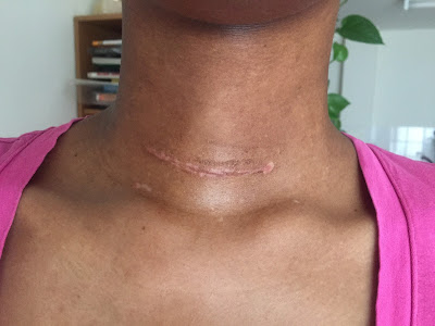 My thyroidectomy journey: One month post-thyroidectomy update