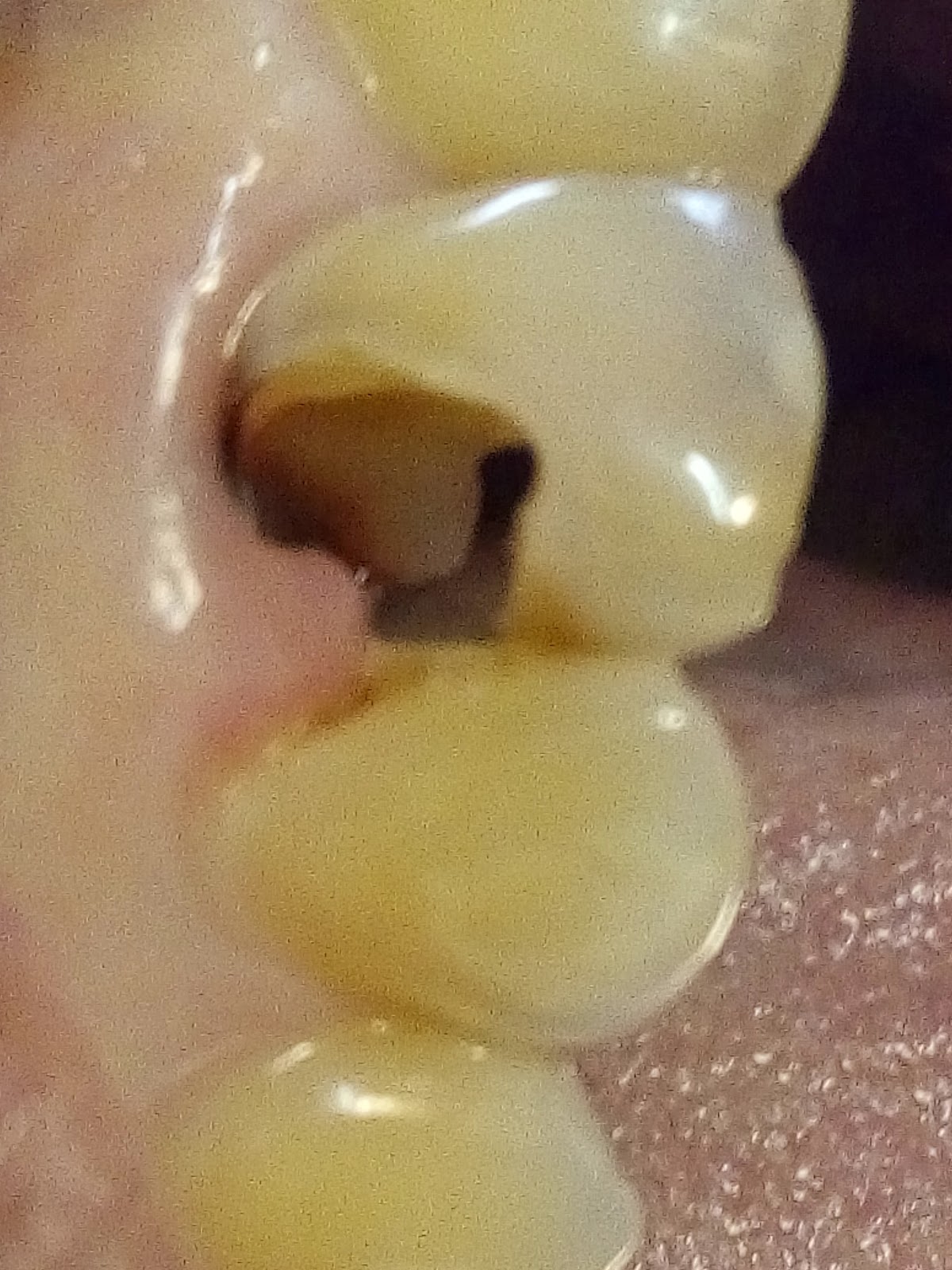 Lemacate Global Dental Clinics: restoration of grossly carious anterior
