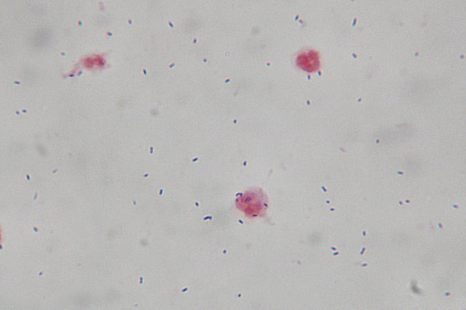 Medical Laboratory and Biomedical Science: CSF Gram Stain Case
