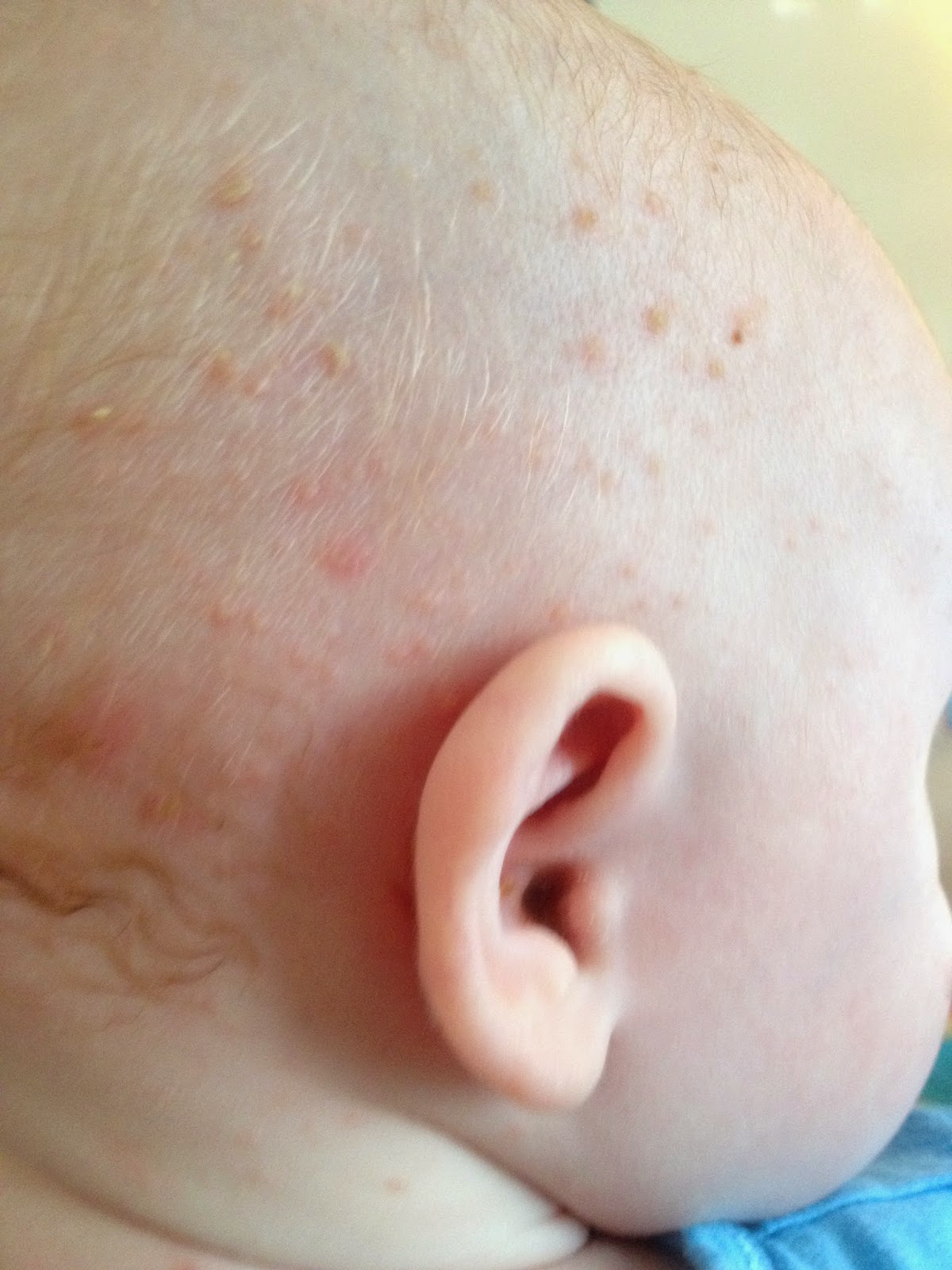 SammyAnne & Bran: Oliver and Langerhans Cell Histiocytosis