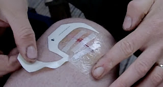 Remote Medicine Ireland: How to use Steri Strips